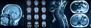 Magnetic Resonance Imaging (MRI)