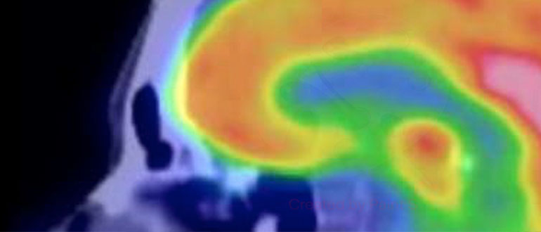 nuclear medicine test